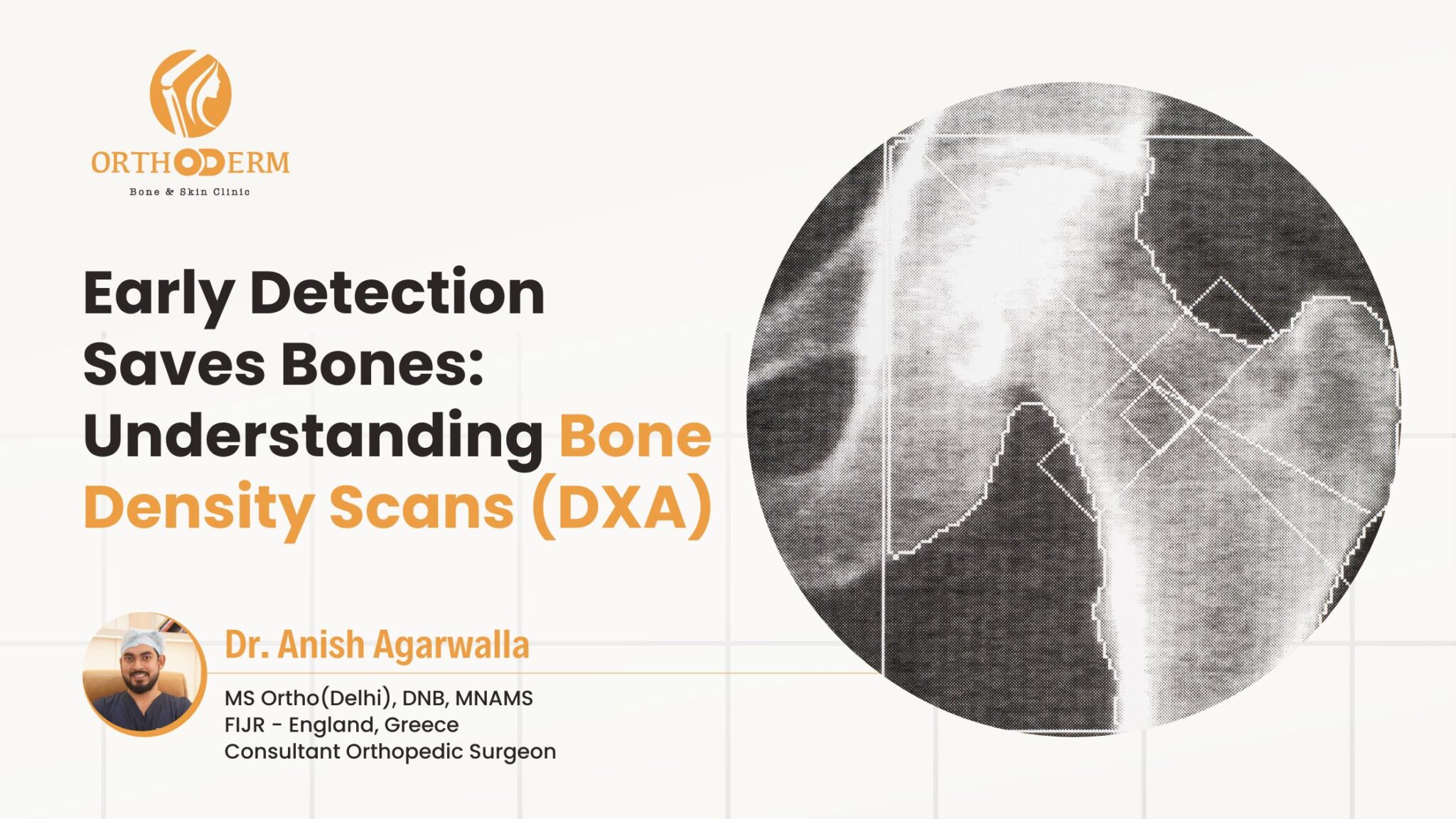 Early Detection Saves Bones: Understanding Bone Density Scans (DXA)